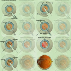 Dr. Tayfour | Cataract Surgery